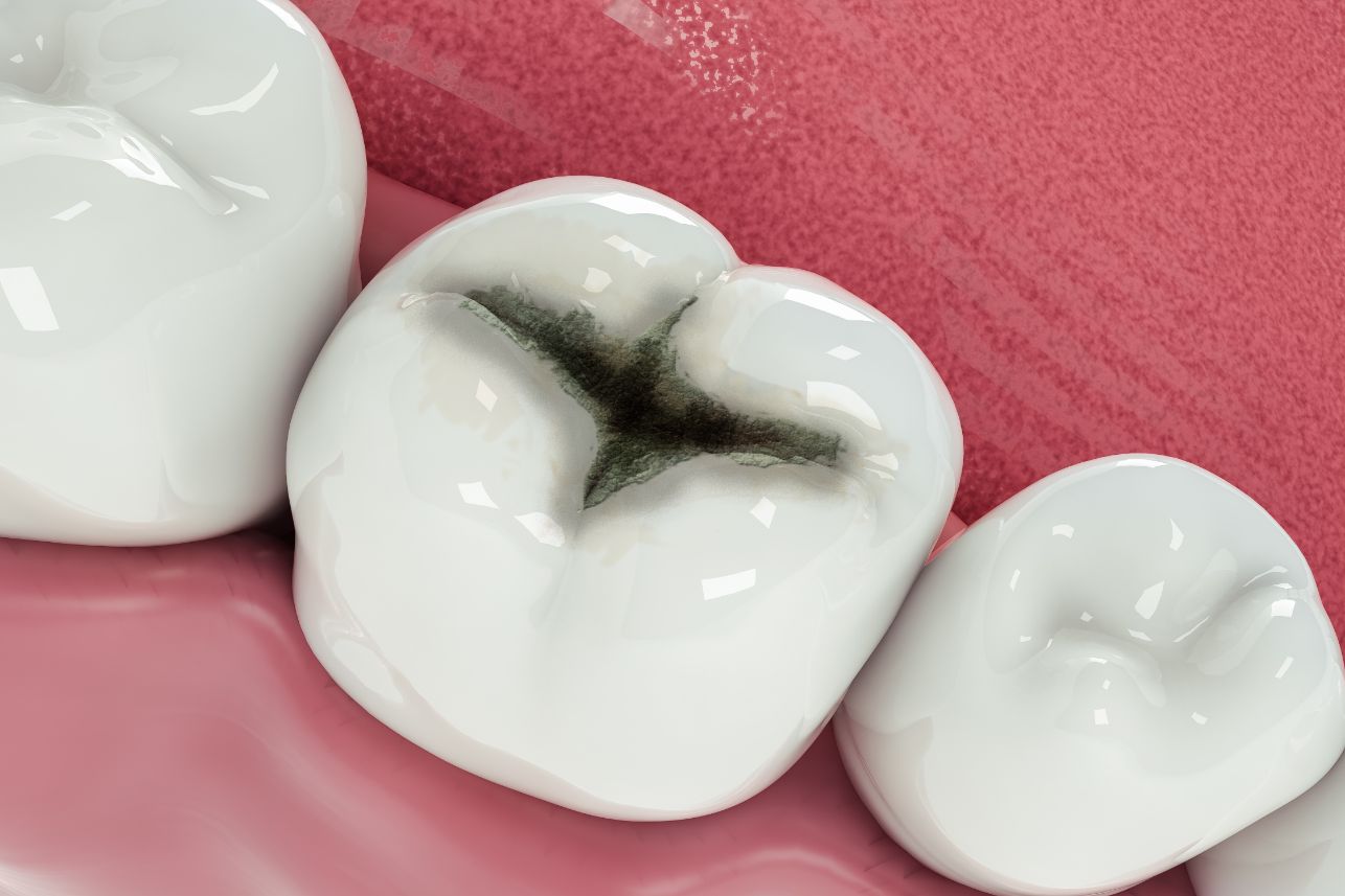 What is Dental Caries? | Causes, Prevention and Treatment